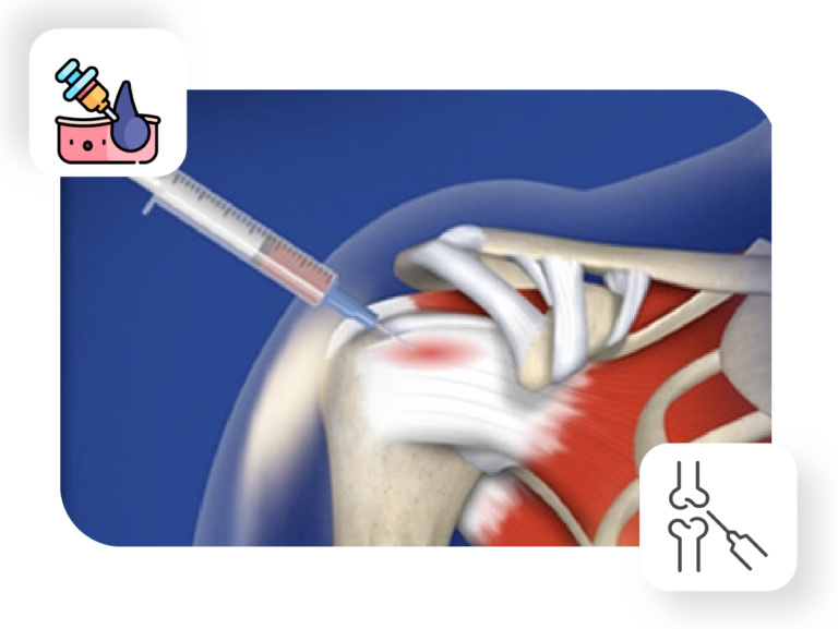 PRP – Pain Release Center